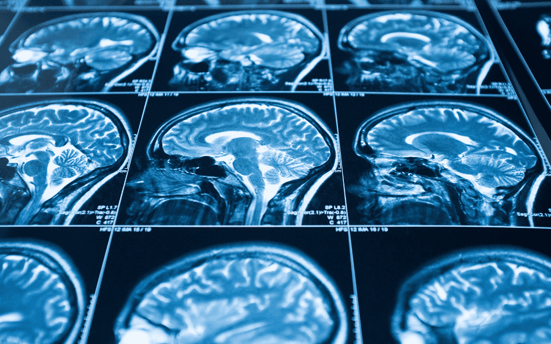 The Default Mode Network – A Key Brain Network in Dissociation and for ...